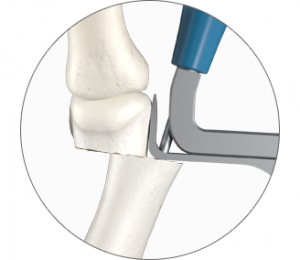 MIS Bunion Correction | Novastep International