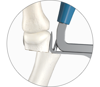 MIS Bunion Correction | Novastep International