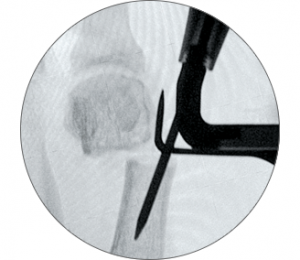 MIS Bunion Correction | Novastep International