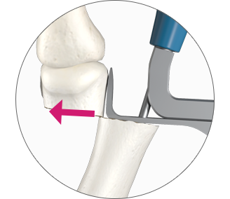 MIS Bunion Correction | Novastep International