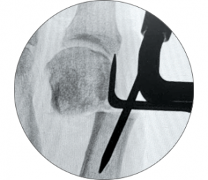 MIS Bunion Correction | Novastep International