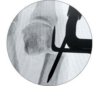 MIS Bunion Correction | Novastep International