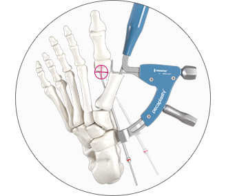 MIS Bunion Correction | Novastep International