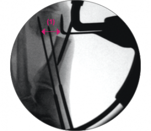 MIS Bunion Correction | Novastep International