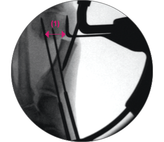 MIS Bunion Correction | Novastep International