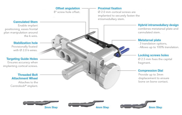 MIS Bunion Correction | Novastep International
