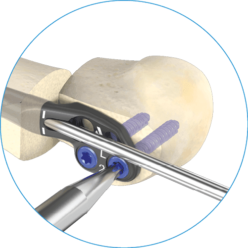 MIS Bunion Correction | Novastep International