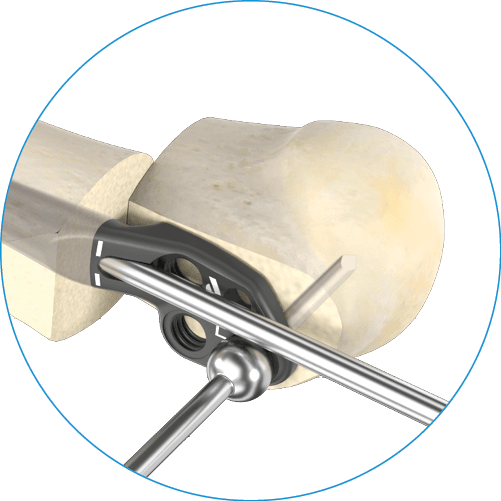 MIS Bunion Correction | Novastep International