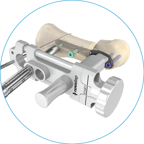 MIS Bunion Correction | Novastep International