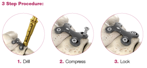 Plantar Lapidus plates | Novastep International