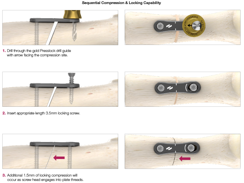 Fusion Plates | Novastep International