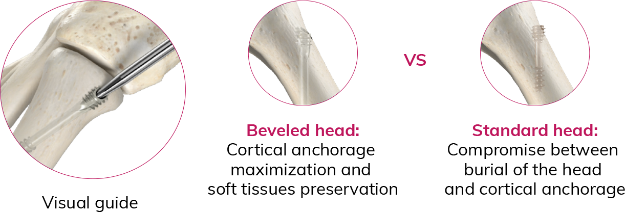 MIS Bunion Correction PECA-C | Novastep International