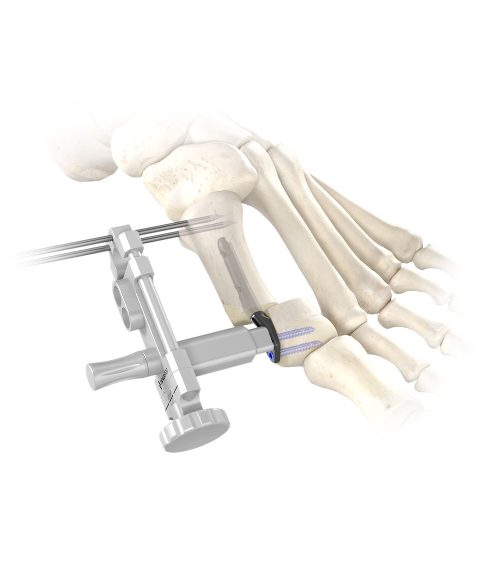 Novastep International | Foot & Ankle Surgery Solutions