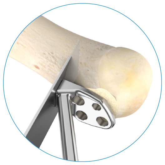 MIS Bunion Correction | Novastep International