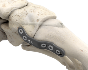 Plantar Lapidus plates | Novastep International