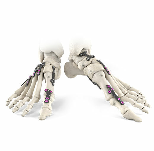 Novastep International | Foot & Ankle Surgery Solutions