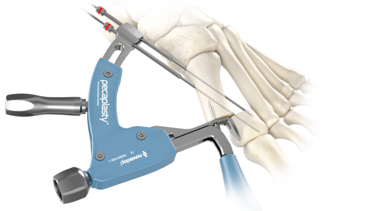 Novastep International | Foot & Ankle Surgery Solutions