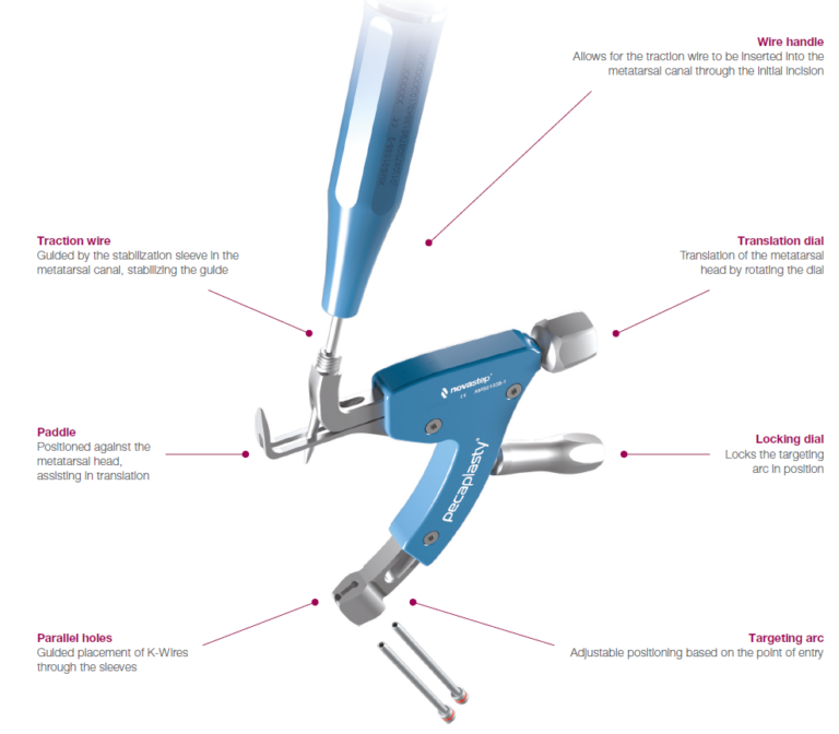 MIS Bunion Correction | Novastep International