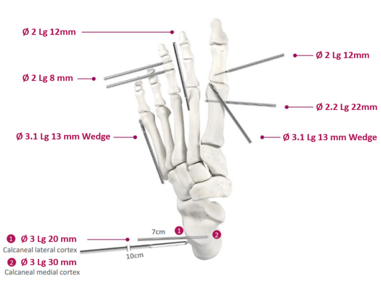 MIS Bunion Correction | Novastep International