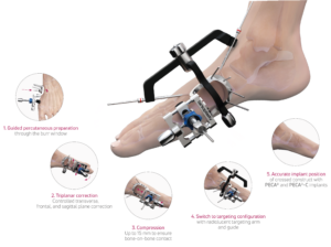 TARSOPLASTY® | Novastep International