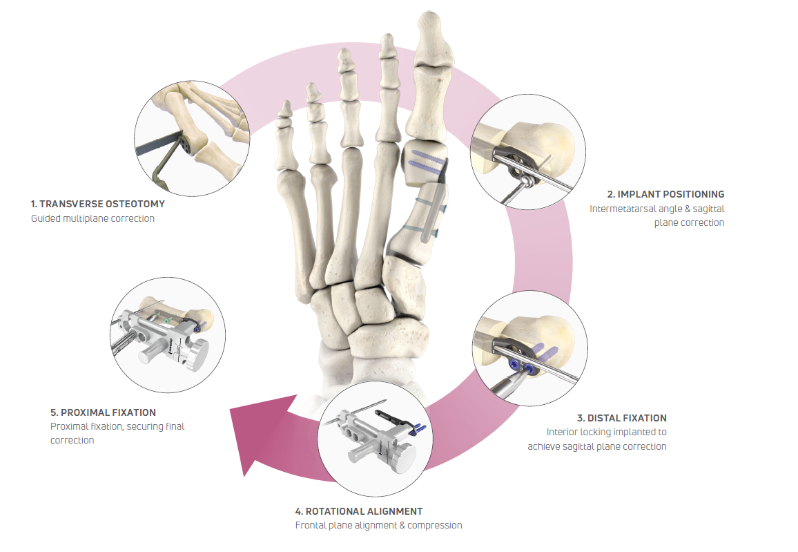 MIS Bunion Correction | Novastep International